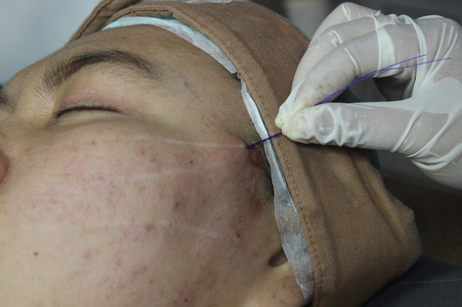 Injectable Treatment - Klinik kecantikan Jember Fast Derm Aesthetic Clinic